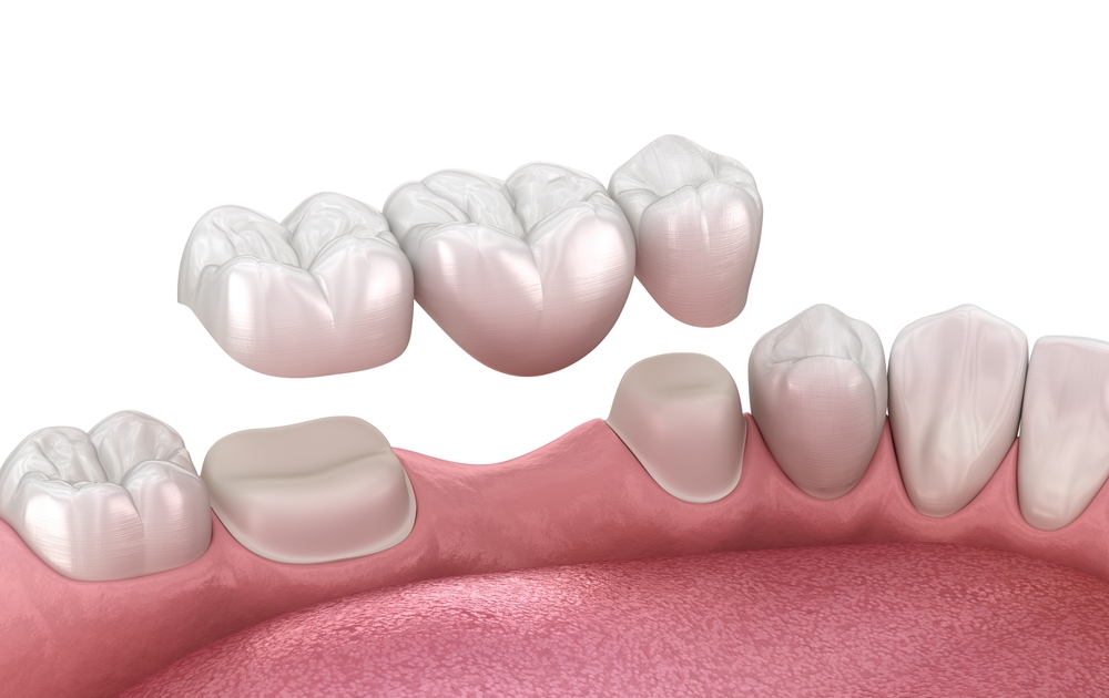 The Benefits Of Dental Bridges For Missing Teeth